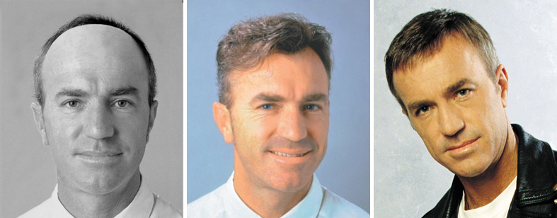 Jacques Kallis Hair Transplant Before And After